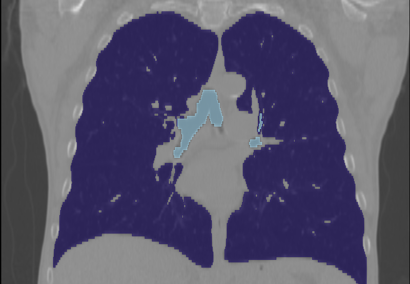 Medical annotation services- CT scan segmentation