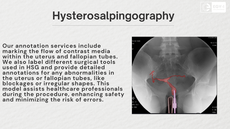 Radiology data annotation |Hysterosalpingography segmentation