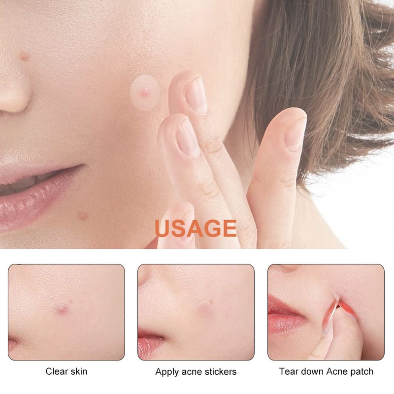 Acne Patches | Pimple Patches - Travel Shop Ng
