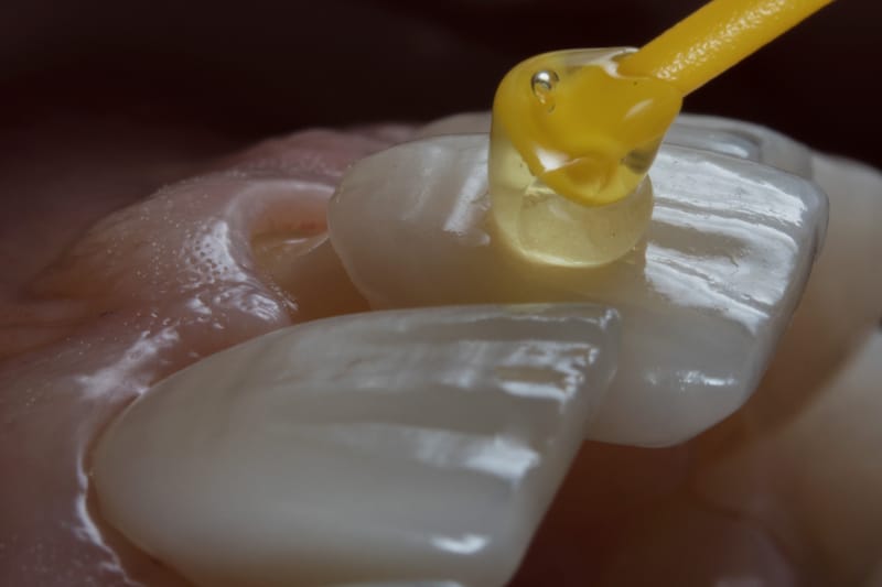 Unveiling the Secrets to a Hollywood Smile: All About Dental Veneers